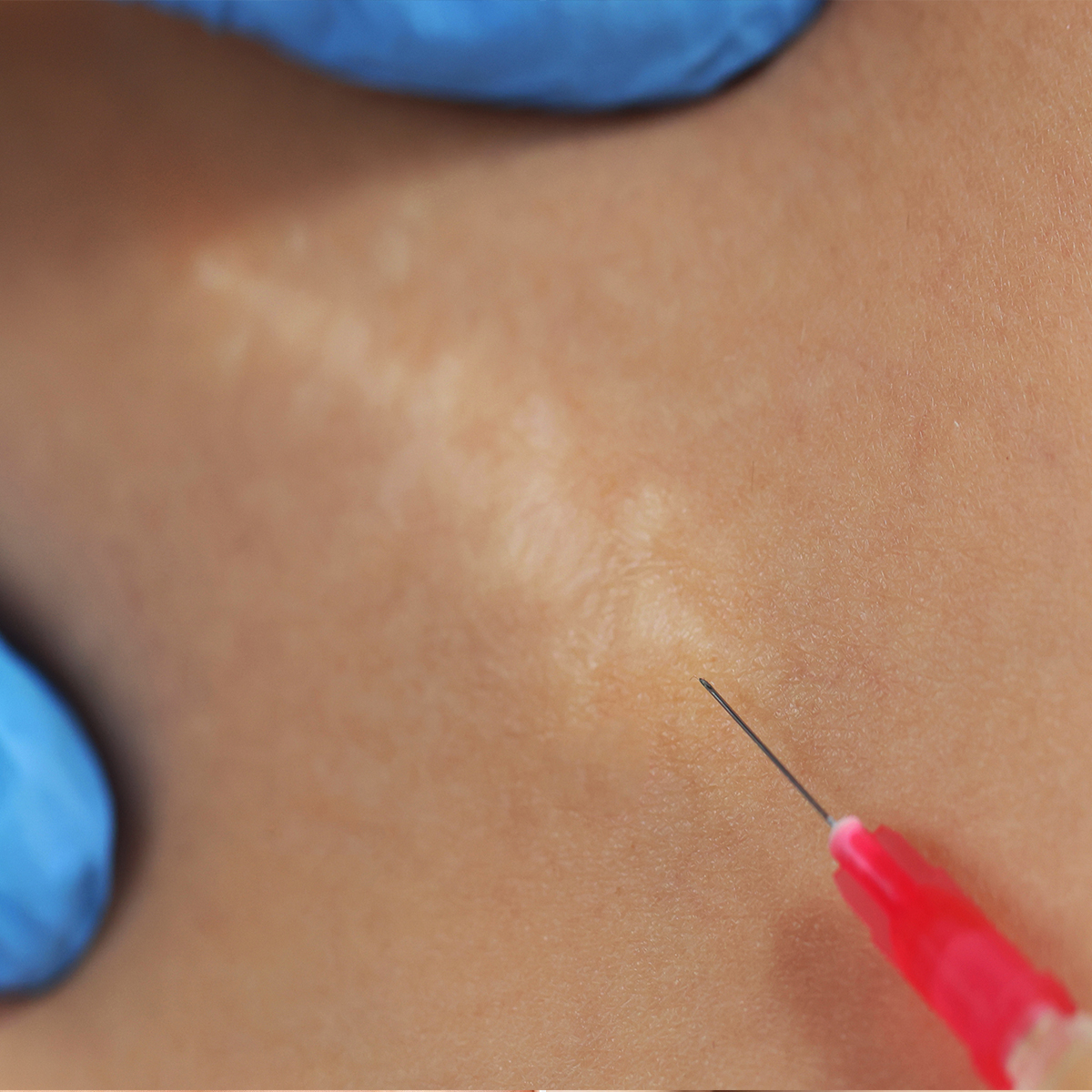 Infiltrazioni intralesionali cheloidi e cicatrici ipertrofiche - Centro ...