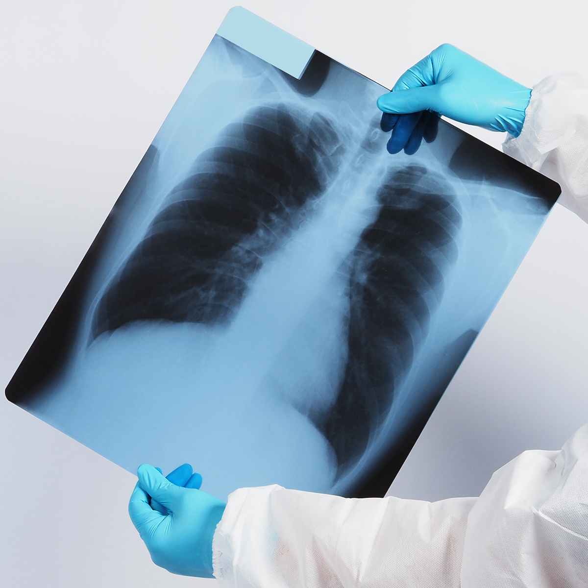 Rx torace - Centro Medico Filippi